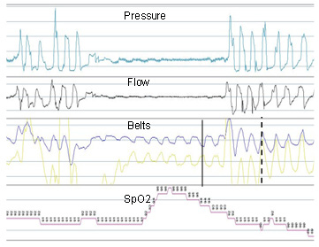 Effort Belts Non-invasive Positive Pressure Ventilation - Education by ...